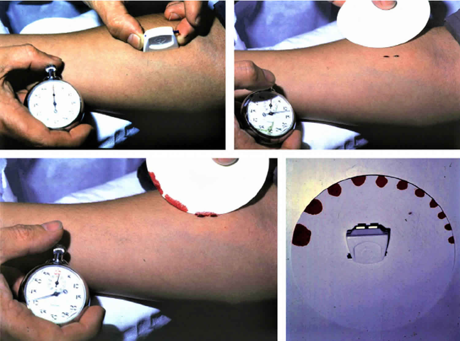 What s The Bleeding Time 